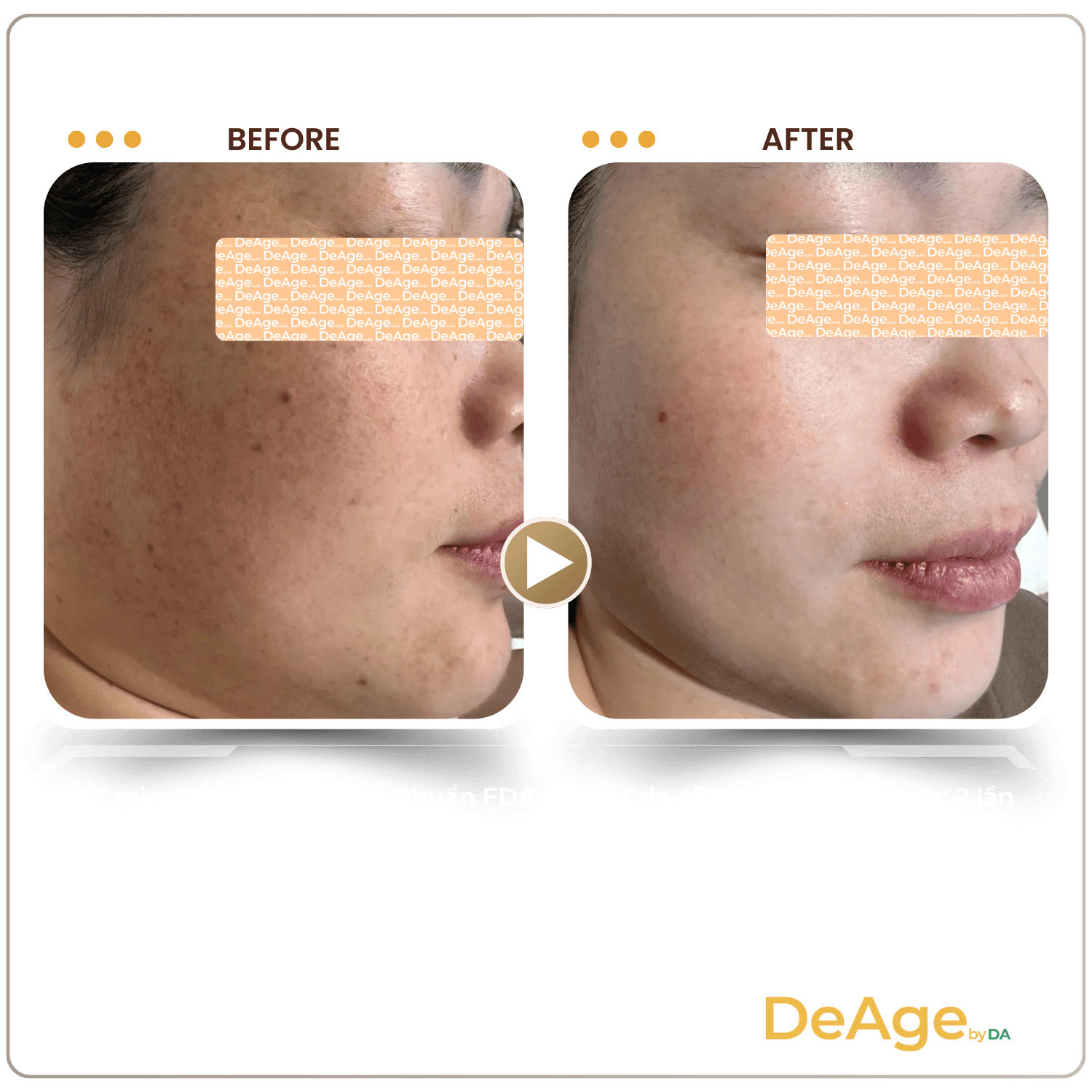Điều trị nám da chuẩn y khoa tại DeAge by DA